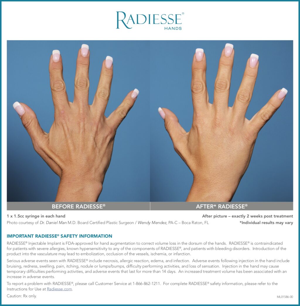 Best Radiesse Los Angeles & Santa Monica | Dr. Tanya Kormeili Dermatology