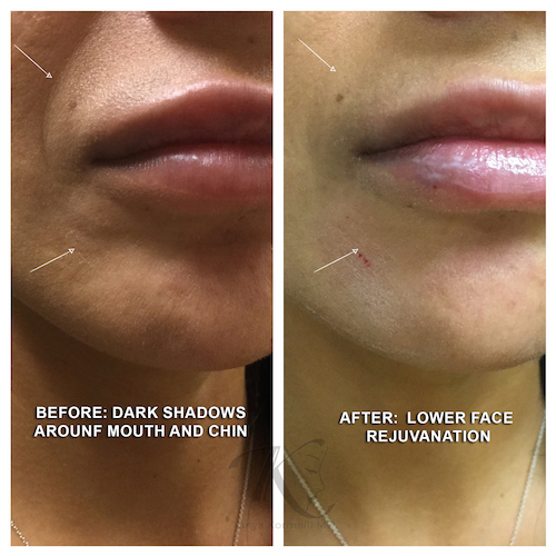 Best FacialVolume Restoration Los Angeles & Santa Monica | Dr. Tanya ...