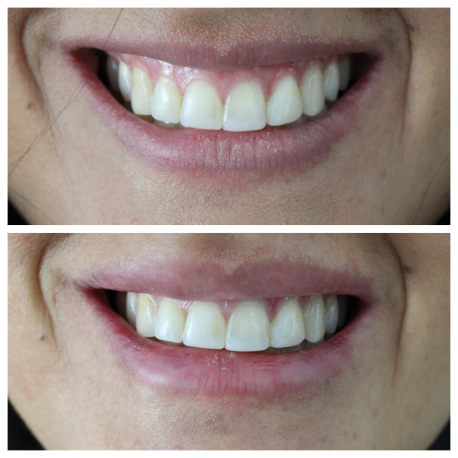 Best Gummy Smile Correction Los Angeles & Santa Monica | Dr. Tanya ...
